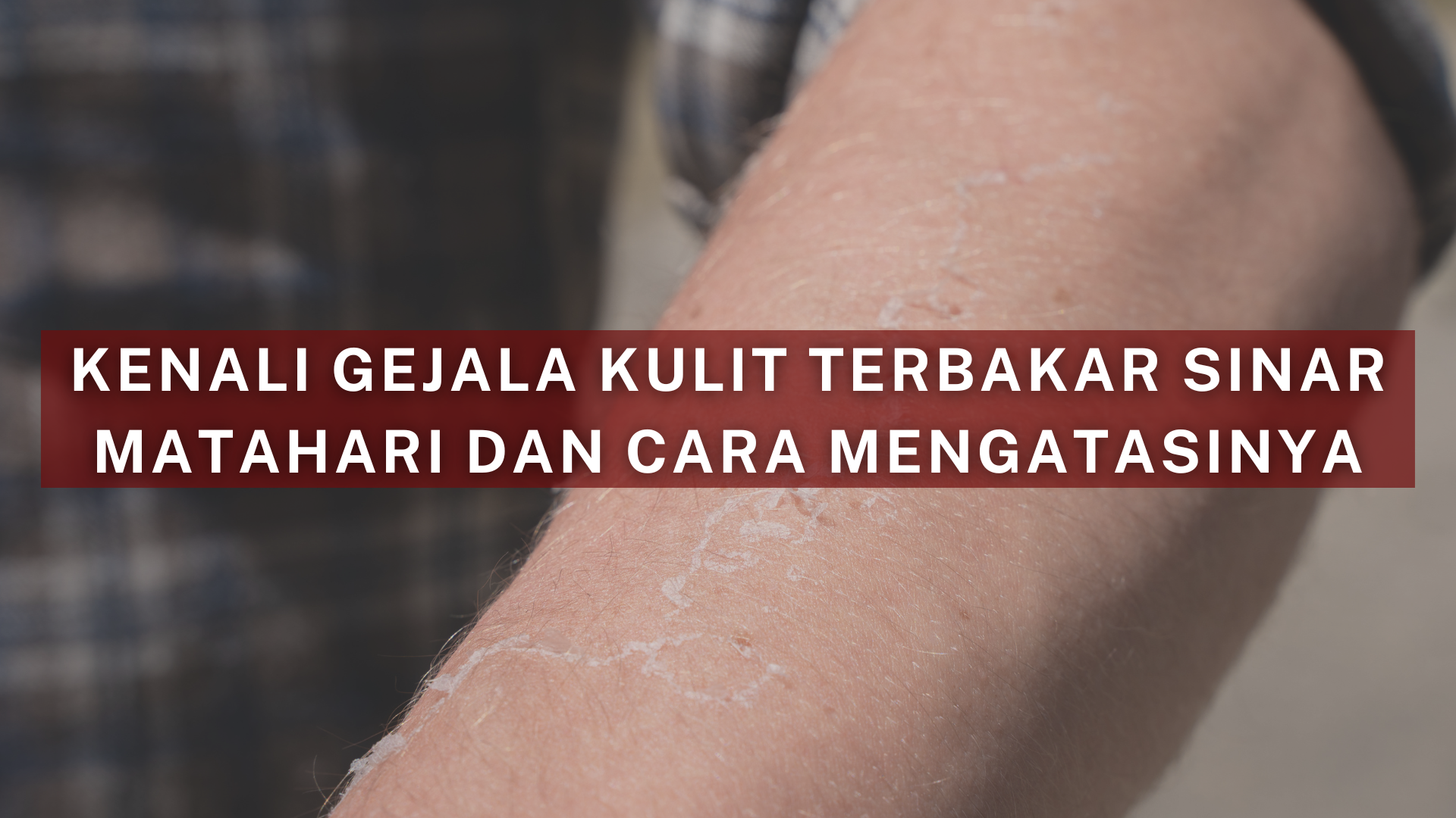 Kenali Gejala Kulit Terbakar Sinar Matahari dan Cara Mengatasinya ...